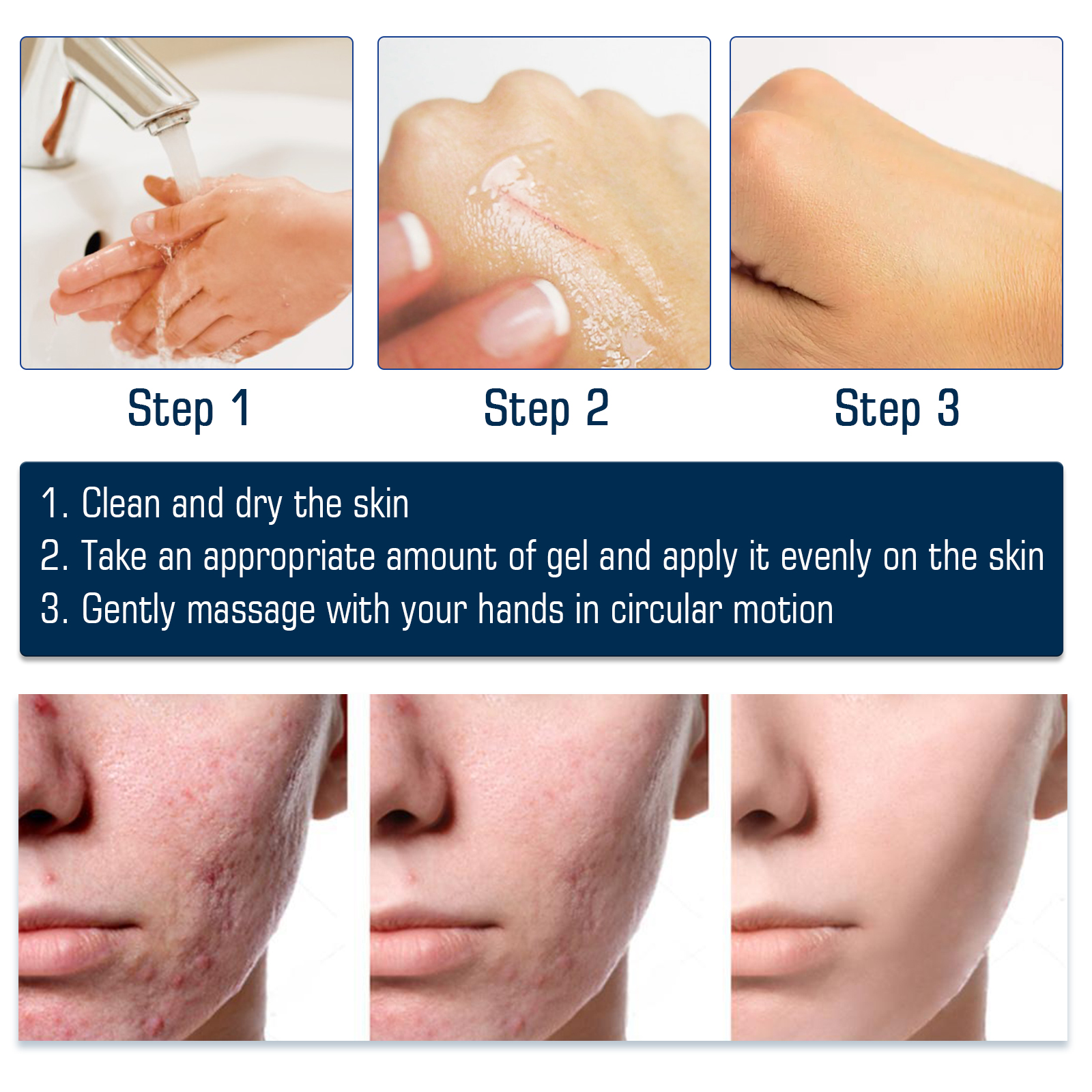 Desalination scar gel - Guangzhou Skin Care manufacturer in China | 15 ...