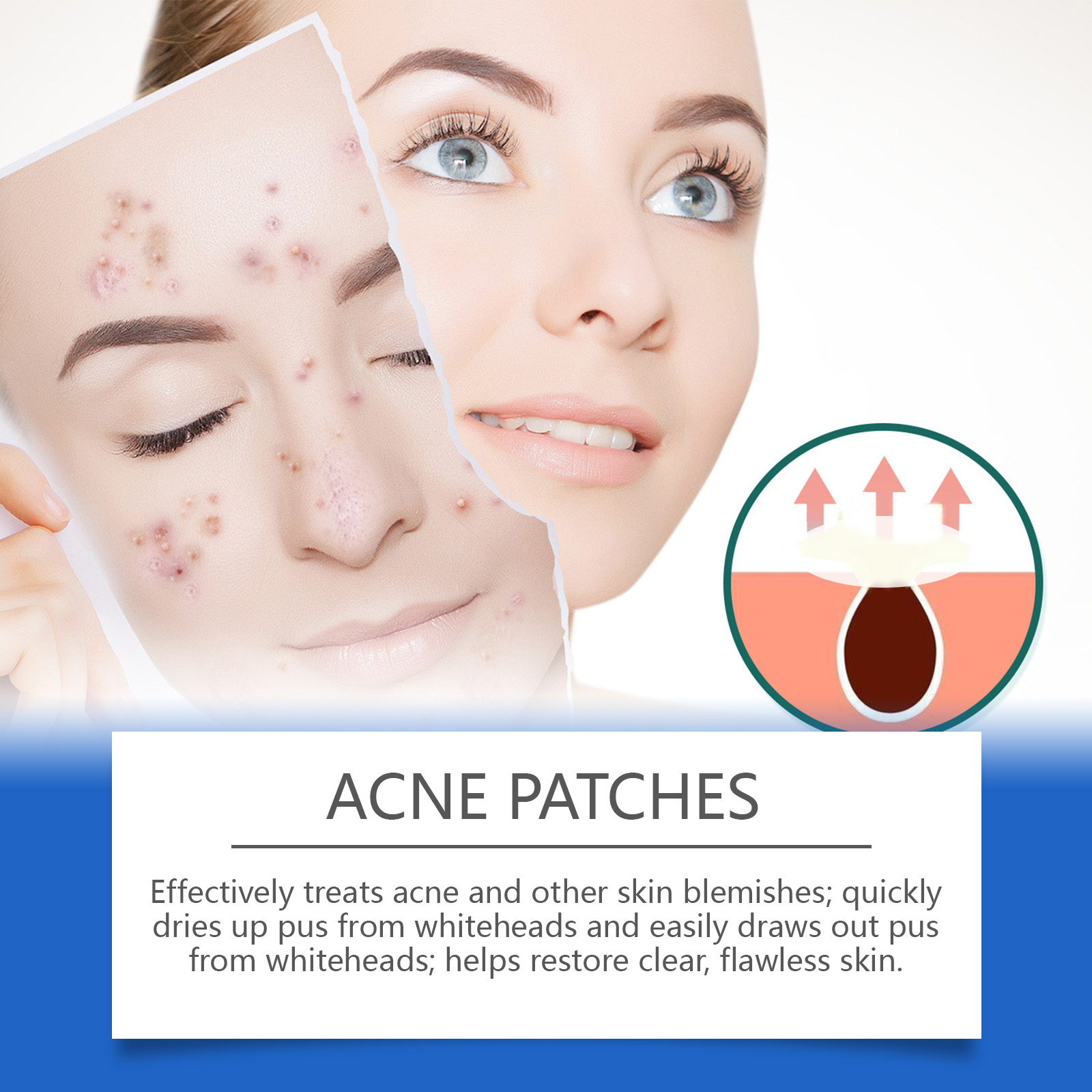 Acne Patch - Guangzhou Skin Care manufacturer in China | 15 years OEM ...
